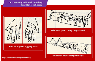 Teknik - Teknik Pembidaian: Pembidaian