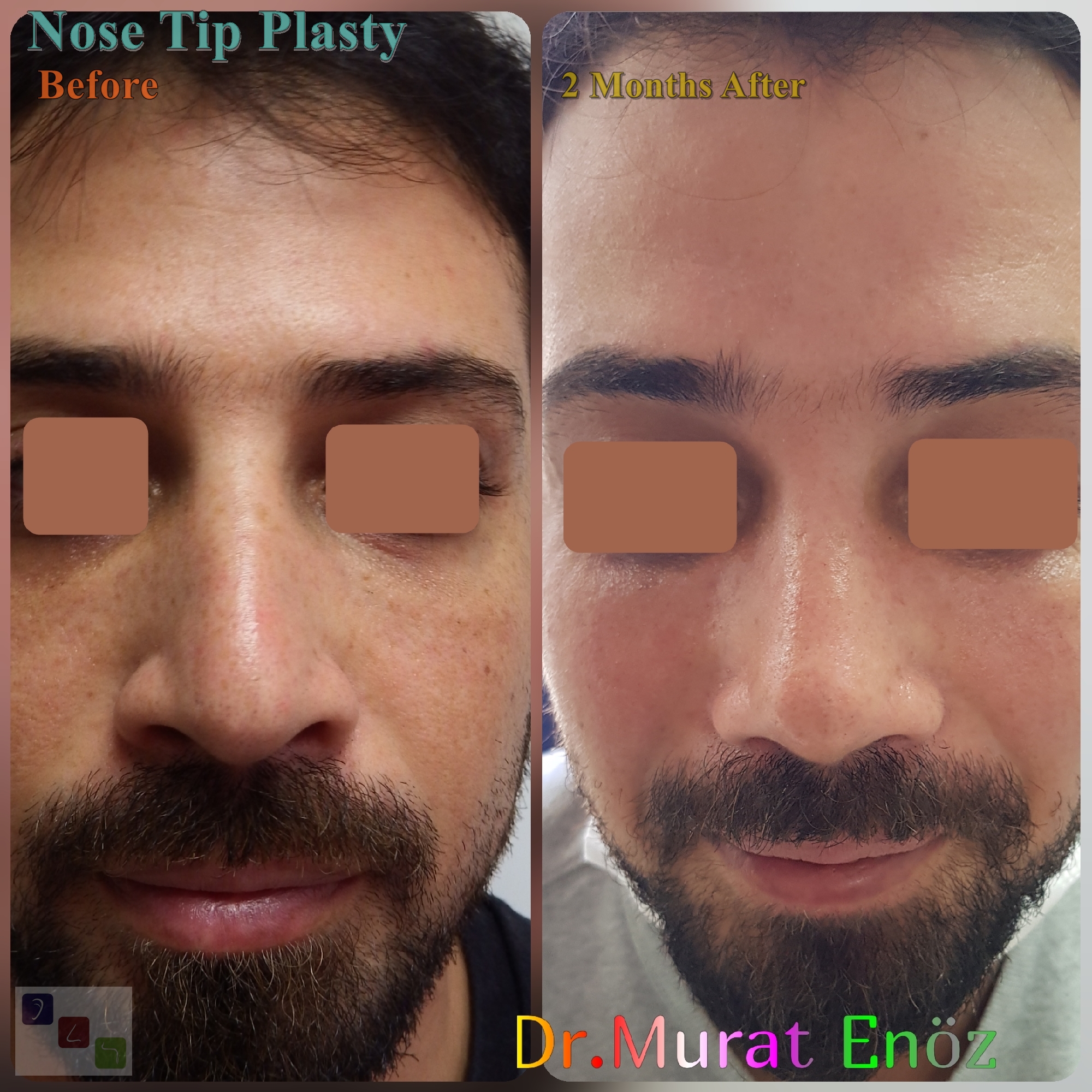 Nasal Tip Plasty and Nose Tip Lifting in Istanbul, Turkey