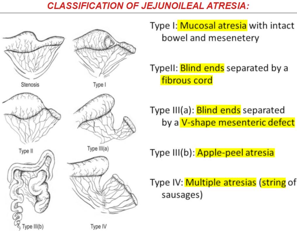 Classification of Jejunoileal Atresia.