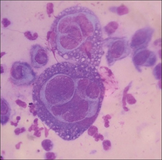 Sacral Herpes: Genital Herpes (HSV-2) Presenting on the Buttock: By ... Sacral Herpes: Genital Herpes (HSV-2) Presenting on the Buttock: By ...