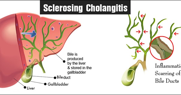 Cholangitis Meaning