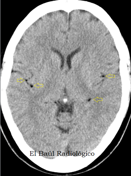 El Baúl Radiológico: 2) QUISTE DERMOIDE INTRACRANEAL (Intracranial ...
