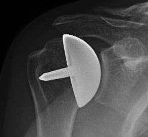 Shoulder Arthritis / Joint Replacement : Humeral resurfacing ...