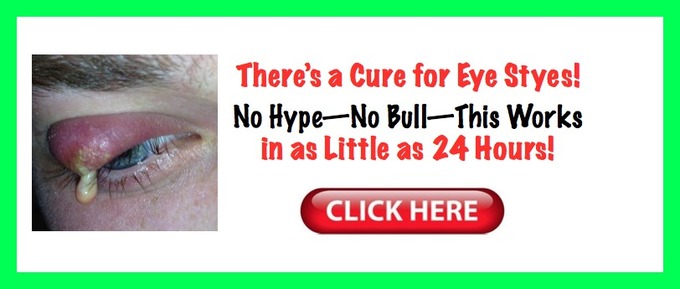 How to Get Rid of a Stye Fast: How to Stop Recurring Styes Frequent Sty ...