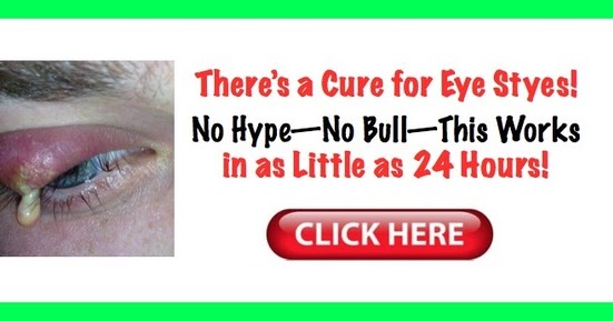 How to Get Rid of a Stye Fast: How to Stop Recurring Styes Frequent Sty ...
