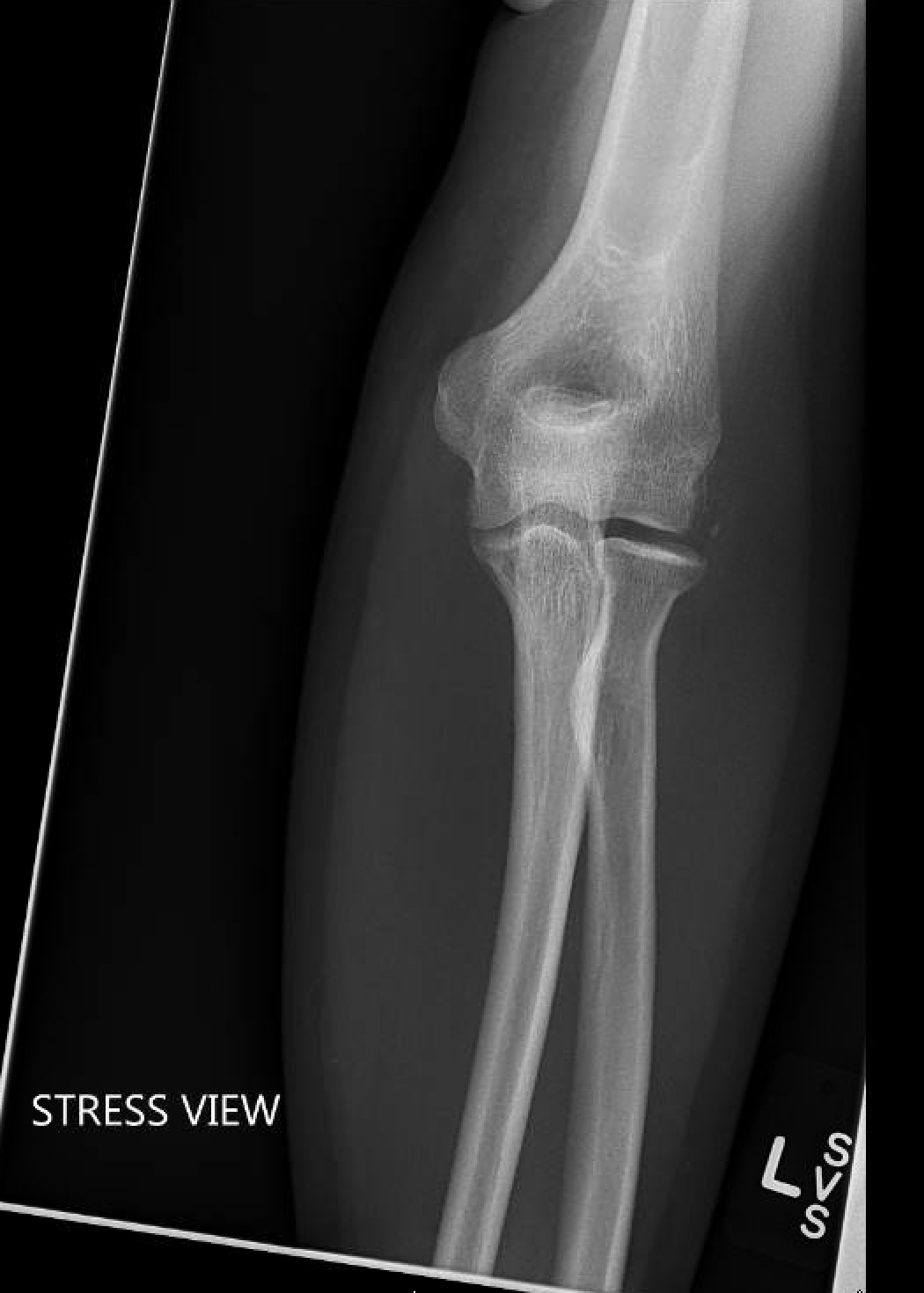 Shoulder and Elbow Surgery: Chronic posterolateral rotatory elbow ...