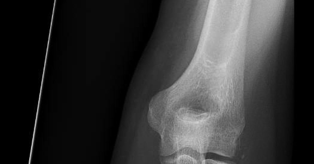 Shoulder and Elbow Surgery: Chronic posterolateral rotatory elbow ...