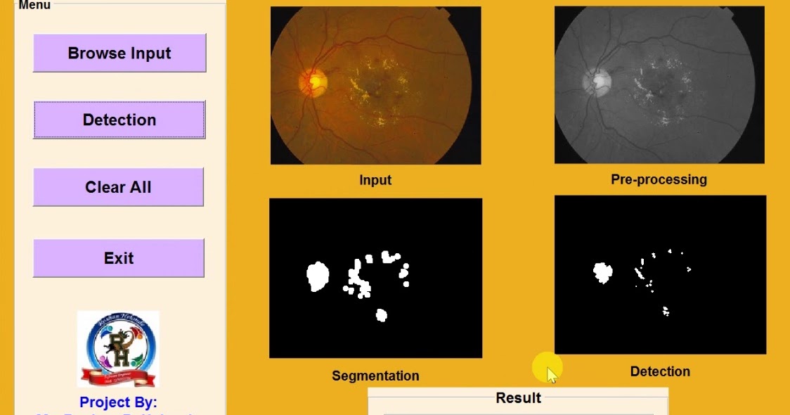 Diabetic Retinopathy Detection Using Convolutional Neural Network Cnn Matlab Project Source Code