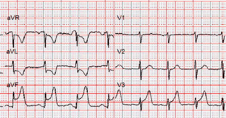 Dr. Smith's ECG Blog: Inferolateral STEMI: is there right ventricular ...