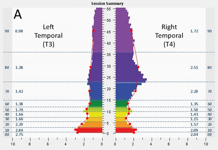 Our Parkinson's Place: Innovative sound therapy treats hypertension and ...