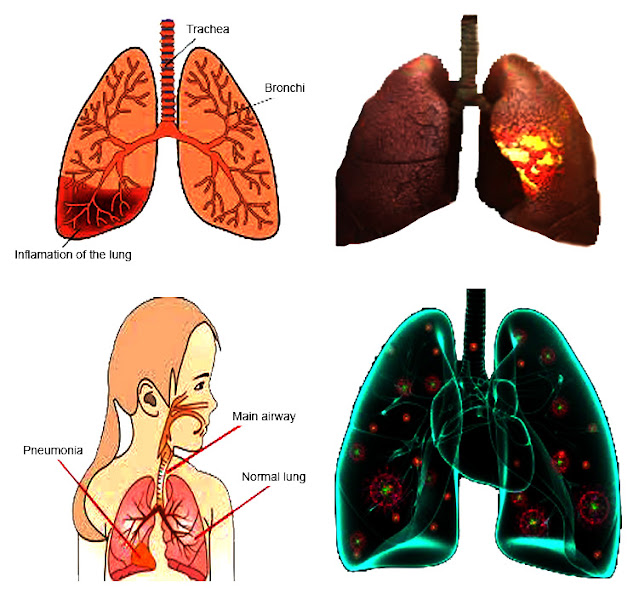 Pneumonia: Symptoms, Causes, Types, Diagnosis, Prevention, and Treatment.