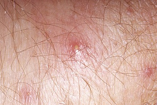 Pioderma - Impetigo Bulosa, Impetigo Non Bulosa, Ektima, Folikulitis ...