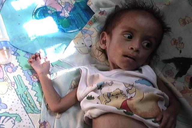 Los Niños de Honduras: La Desnutricion