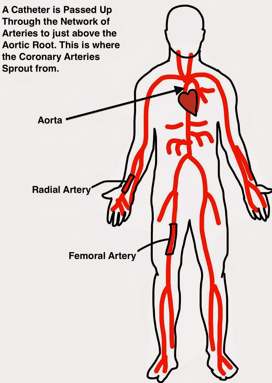 My Take: Straight from the Heart (III) : (Angioplasty, 1999) The Story ...