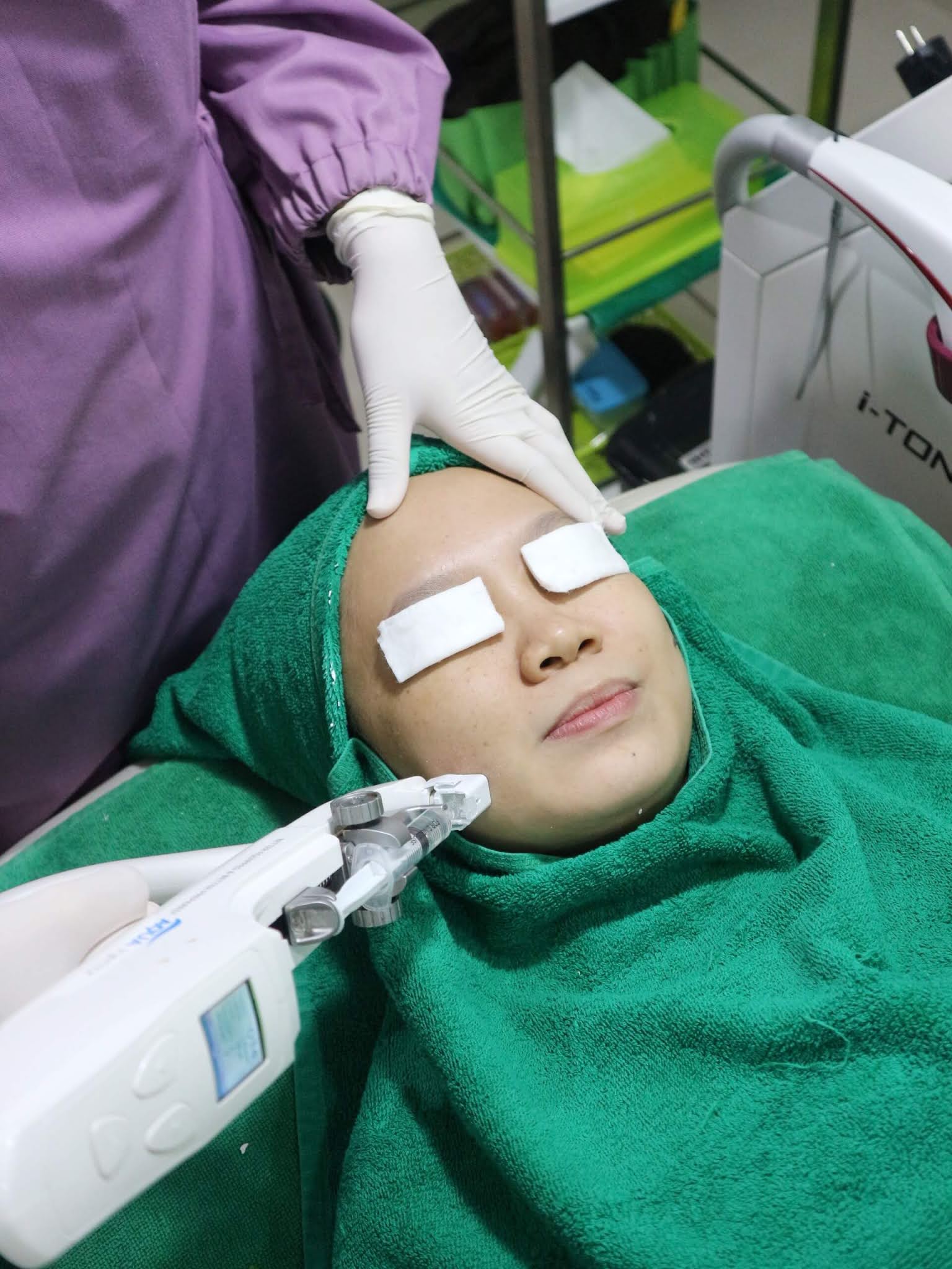 Perawatan Mesotherapy di Azqiara Klinik Yogyakarta - Marlina