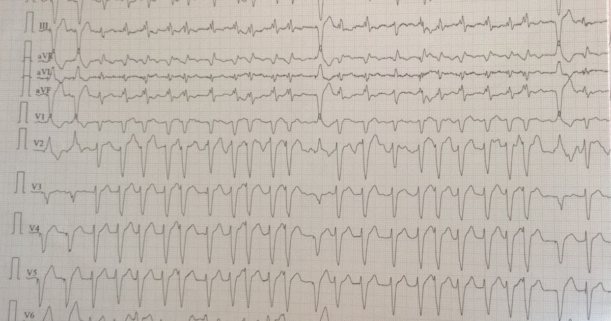 Cardiology window: Atrial fibrillation with fast ventricular rate in a ...