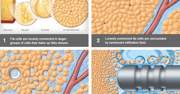 지방흡입/지방이식 정보블로그: 지방흡입 시, 베이저(VASER) 장비와 다른 장비의 비교 Compare VASER Lipo ...