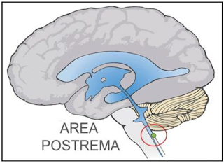 Esclerosis-Multiple-MSblog: Area Postrema Syndrome and Neuromyelitis ...