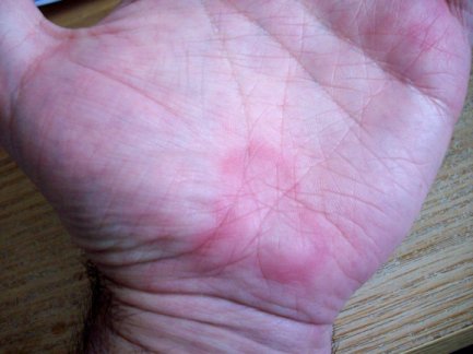 Hives On Palms Of Hands