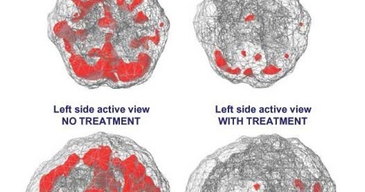 Gulin Aydin, MSW, RSW : Brain Scan (Before and After EMDR)