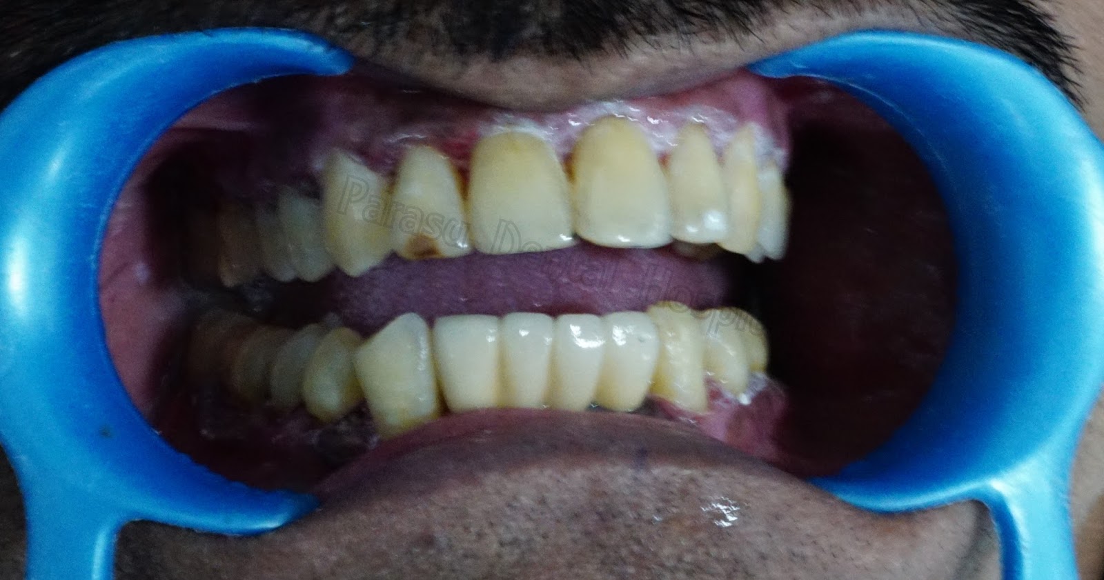 dental implants cost in chennai,India: Missing Tooth Replacement in Chennai