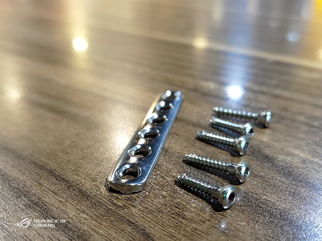 Pengalaman Operasi Pasang dan Lepas Pen Patah Tulang di Lengan Tangan ...