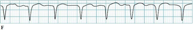 Wide Complex Tachycardia Case File