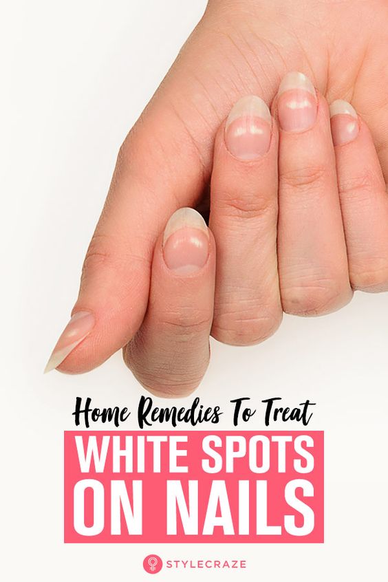 Treat White Spots On Nails with Home Remedies Treat White Spots On Nails with Home Remedies