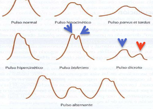 pulso bisferens cardiologia