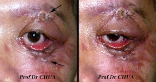 Eyelid Surgery by Prof Dr CN CHUA 蔡鐘能: A Patient who Can’t Close His ...