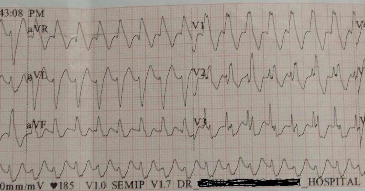 Cardiology window: Left anterior fascicular ventricular tachycardia