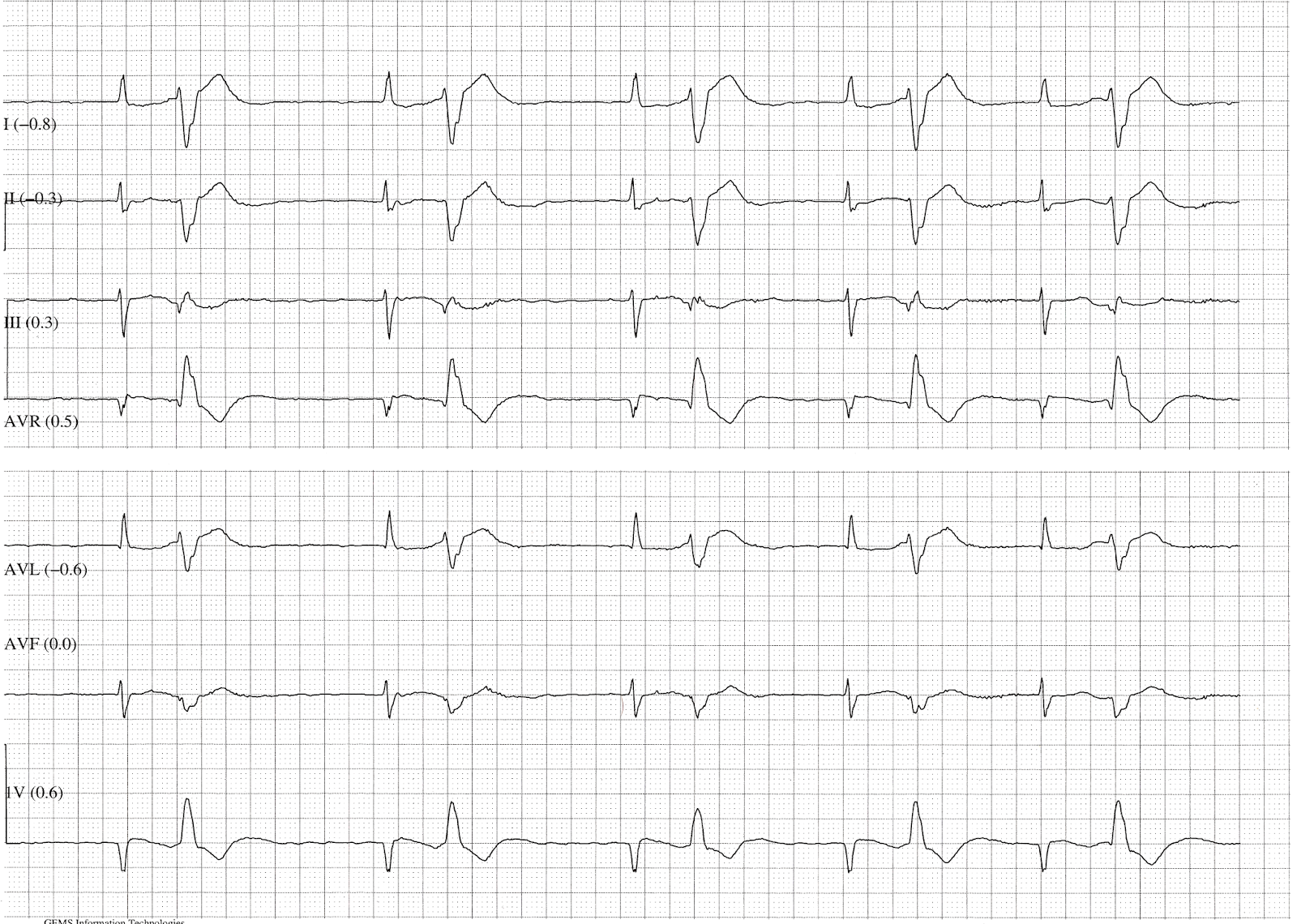 Ventricular Bigeminy