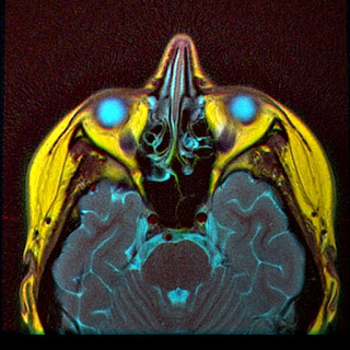Nevit's blog: Color MRI of Orbita