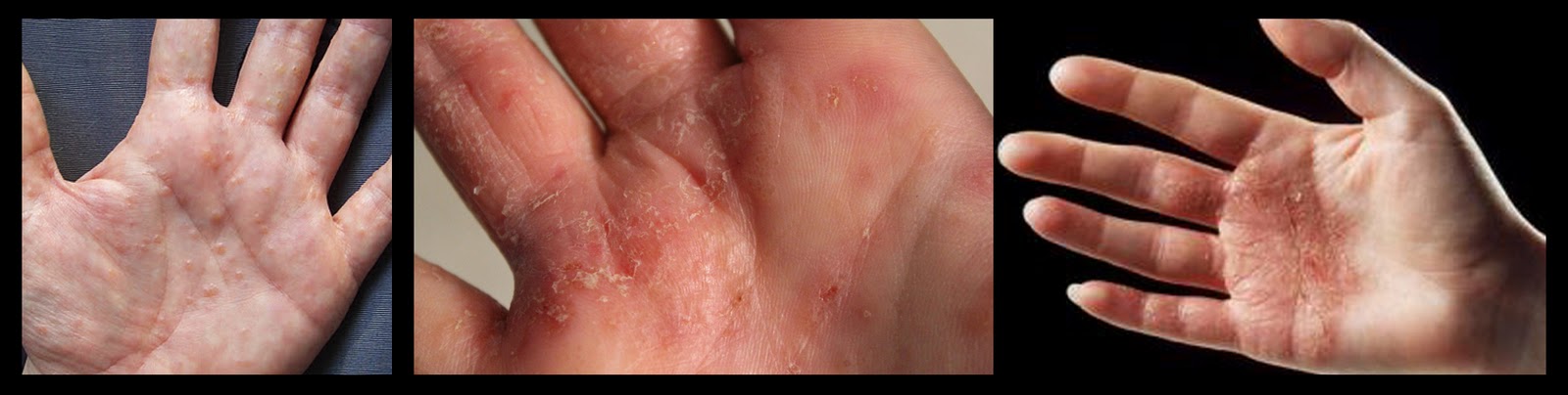 EKCEM - s hrano proti ekcemu - kako sem premagala to bolezen