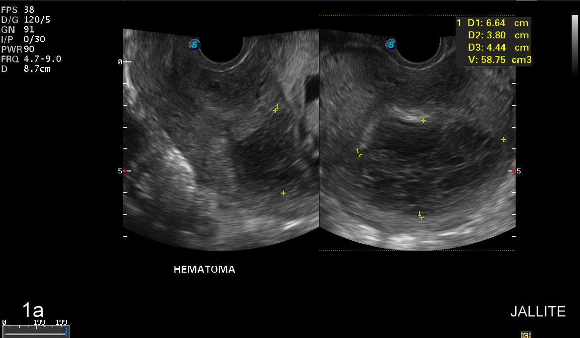 Hematoma Retrocorionico & Placenta Marginal