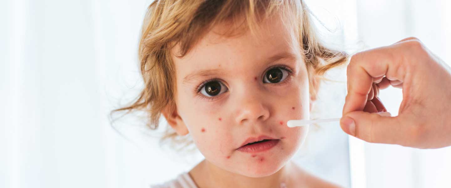 Su çiçeği nedir? Belirti ve tedavi yöntemleri nelerdir? - İLK LAF SOKUCU