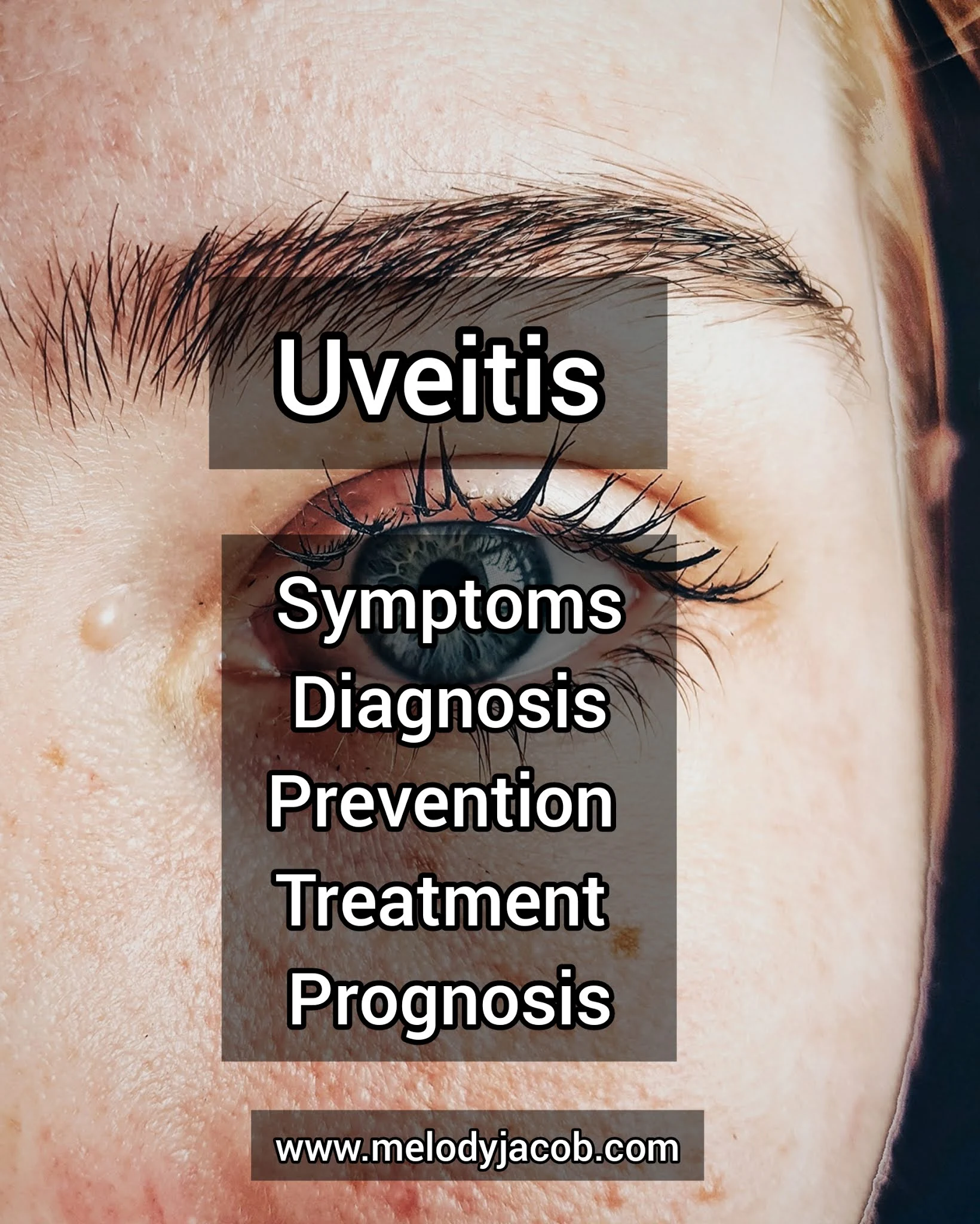 Uveitis: Causes, Symptoms, Prevention and Treatment | Melody Jacob