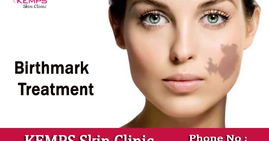 Birthmark Types, Causes, and treatment | KEMPS Skin Clinic