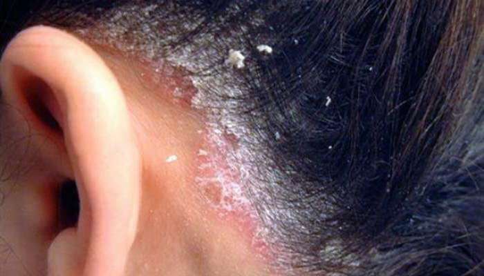 Salud Y Belleza: Remedios caseros para combatir la caspa y la seborrea