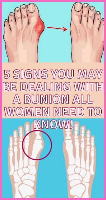 Bunion – Symptoms, Diagnosis And Treatment - Healthy Lifestyle