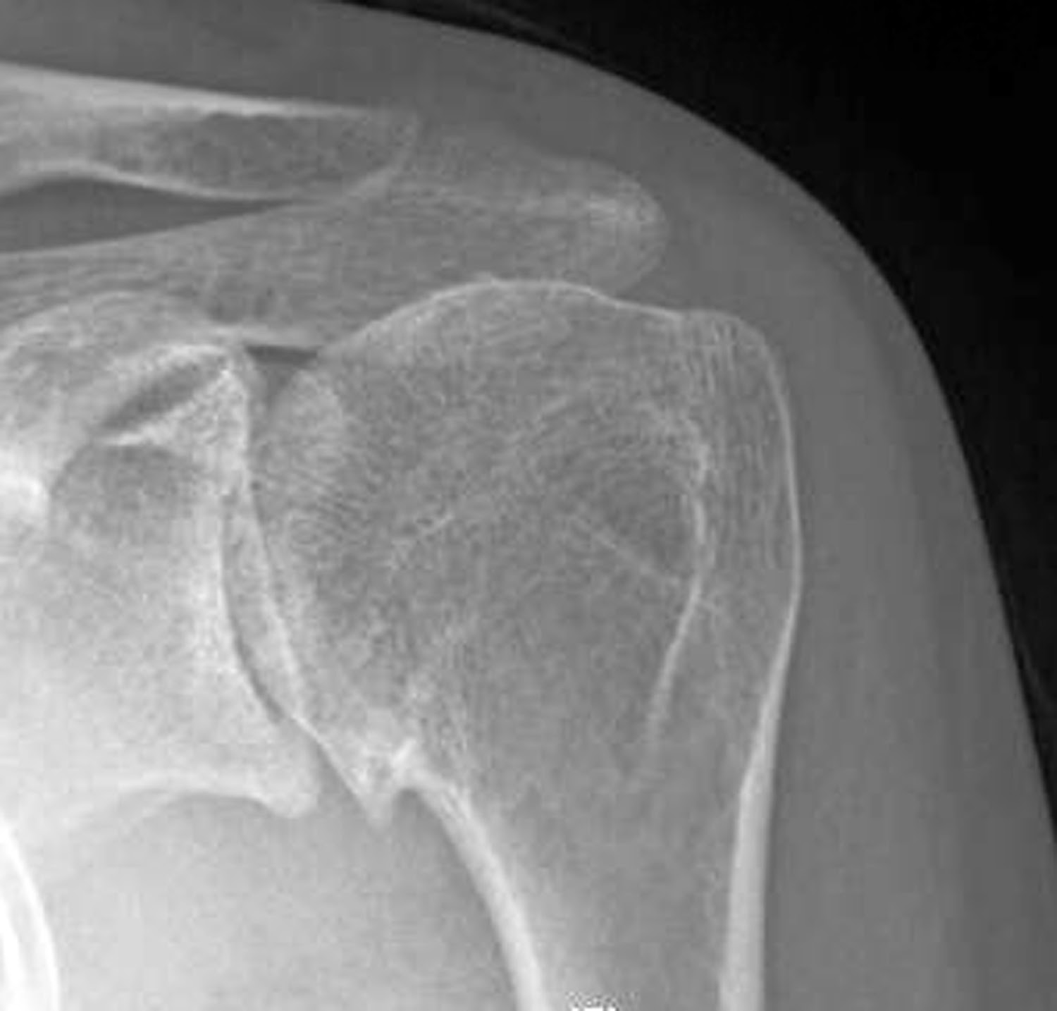 UW Shoulder and Elbow Academy: Shoulder joint replacement - many ...