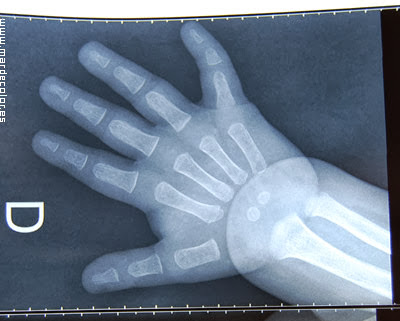 Educación Física en la Red: La edad ósea nos indica si un niño aún ...