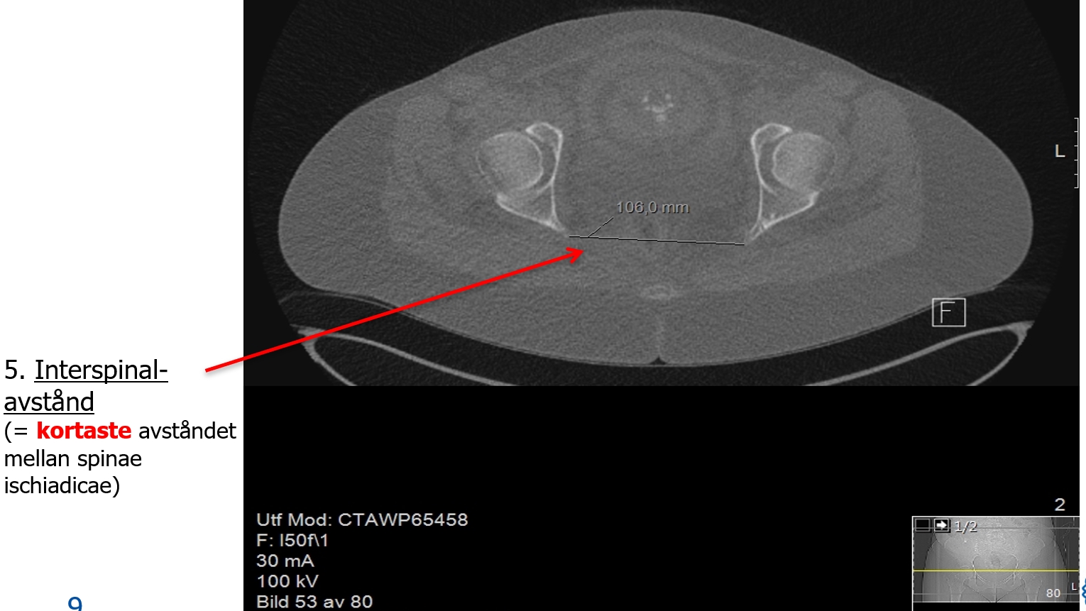 CT Pelvimetry - Bäckenmätning