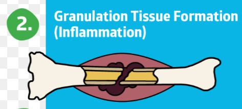 All about physiotherapy: STAGES OF FRACTURE HEALING WITH DIAGRAMS