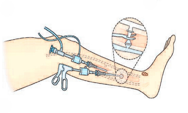 靜脈曲張的各種治療方法與歷史｜許原彰醫師：高雄宇成診所