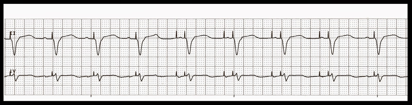 Practice EKG Strips 415