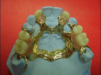 Get your smile on!: Finest Class 3 Removable Partial- composite fused ...
