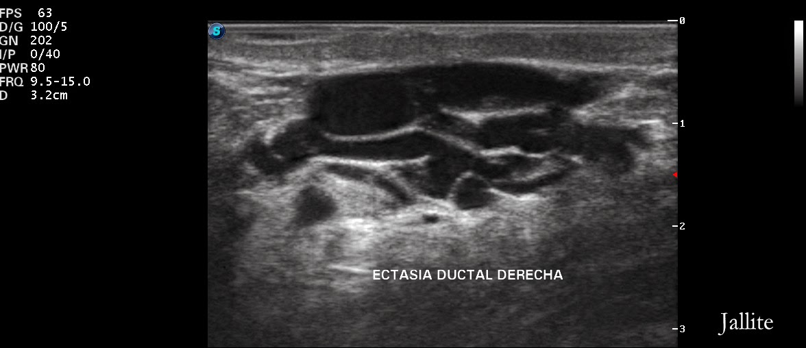 Ectasia Ductal