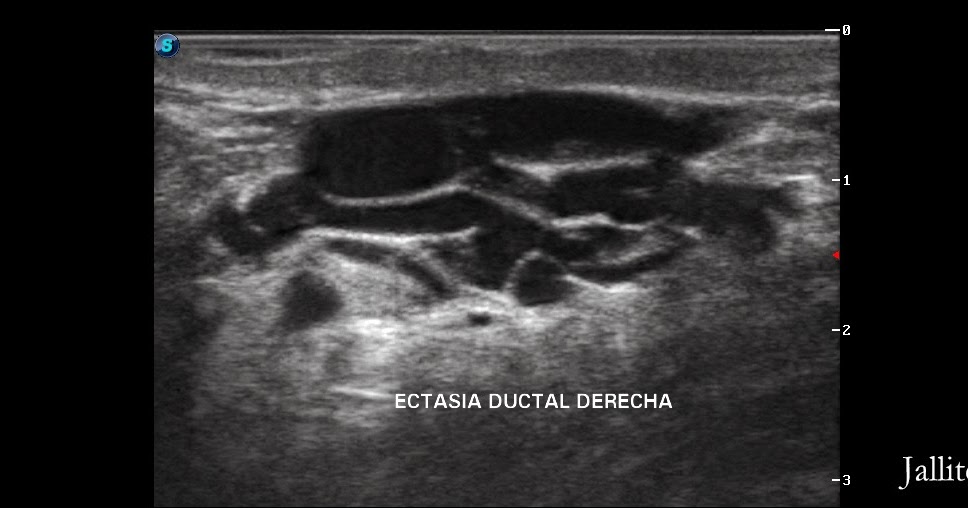 Ectasia Ductal