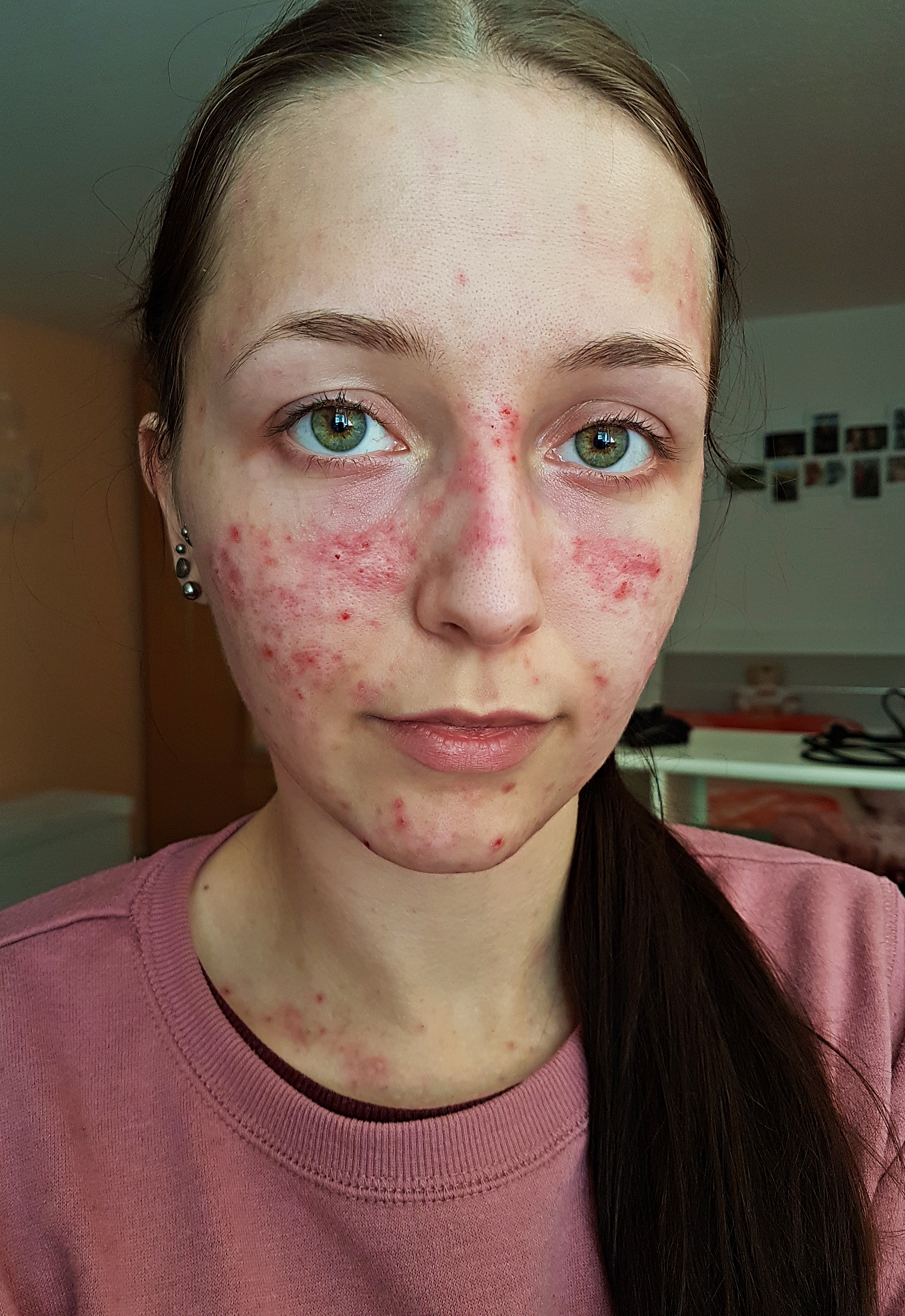 Mein Leben mit Skin Picking/Dermatillomanie: Prokrastinationsdrücken